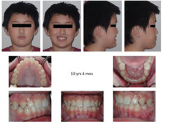 Early Orthodontic Treatment - Oral Health Group