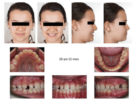 Early Orthodontic Treatment - Oral Health Group