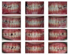 Early Orthodontic Treatment - Oral Health Group