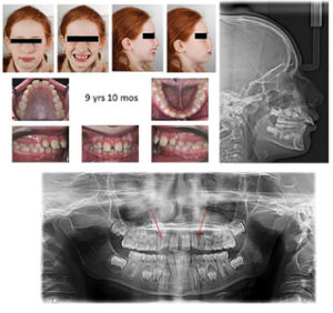 Early Orthodontic Treatment - Oral Health Group