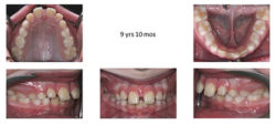 Early Orthodontic Treatment - Oral Health Group