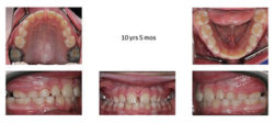 Early Orthodontic Treatment - Oral Health Group