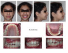 Early Orthodontic Treatment - Oral Health Group