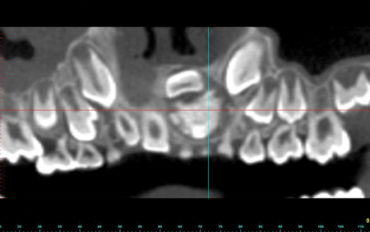 Management of Benign Odontogenic Lesions in the Paediatric Patient