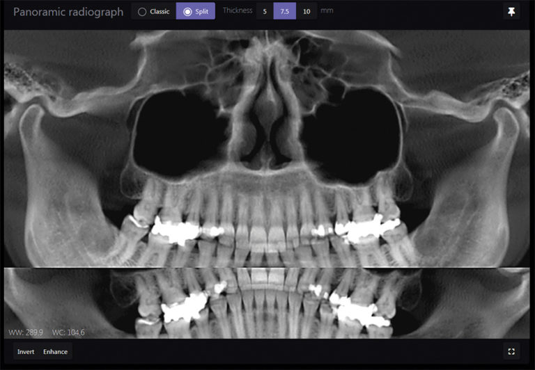 Artificial Intelligence and Deep Learning in Dental Radiology