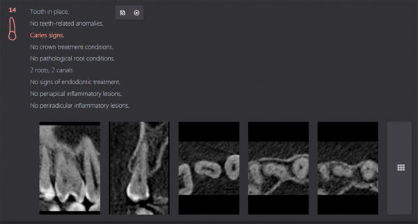 Artificial Intelligence and Deep Learning in Dental Radiology