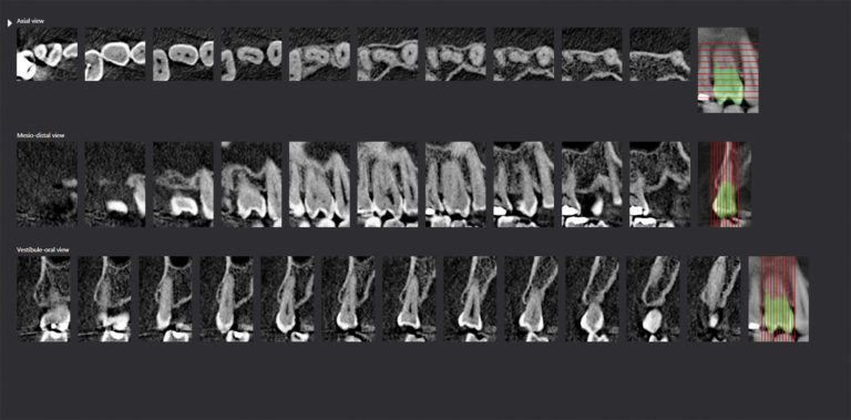 Artificial Intelligence and Deep Learning in Dental Radiology