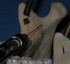Mandibular Anesthesia: Troubleshooting and Overcoming Failure to ...