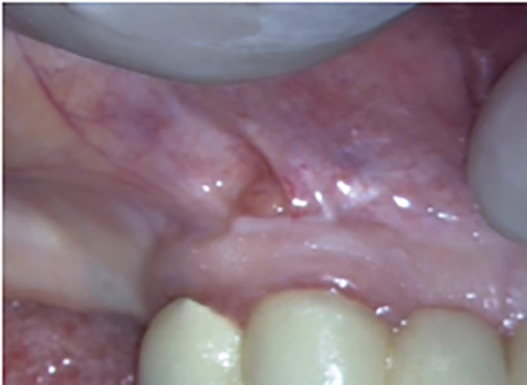 Apicoectomy Performed Using the Er,Cr:YSGG Laser System