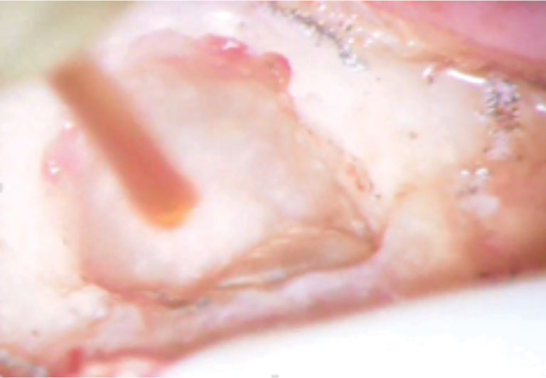 Apicoectomy Performed Using the Er,Cr:YSGG Laser System