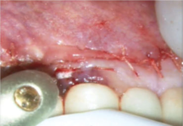 Apicoectomy Performed Using the Er,Cr:YSGG Laser System