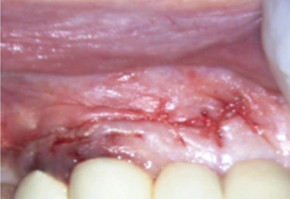 Apicoectomy Performed Using the Er,Cr:YSGG Laser System