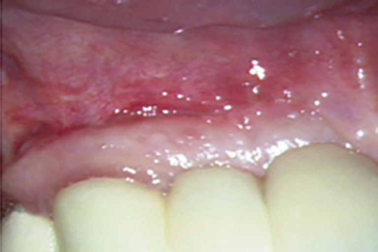 Apicoectomy Performed Using the Er,Cr:YSGG Laser System