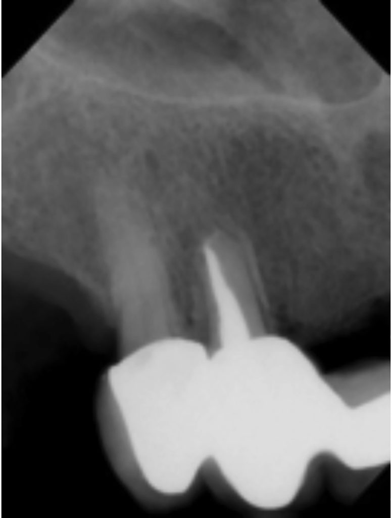 Apicoectomy Performed Using the Er,Cr:YSGG Laser System