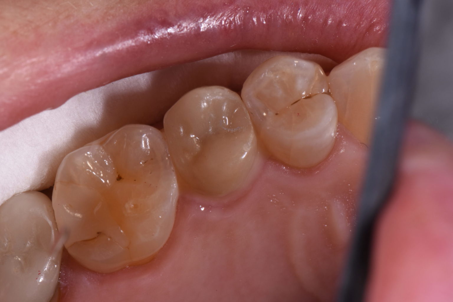 Cementing Crowns with Activa Bioactive Cement - Oral Health Group