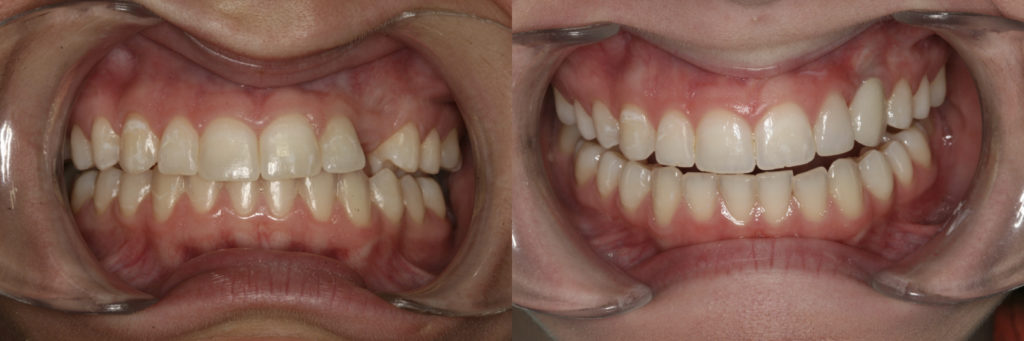 Case Study: The Missing Canine – A Puzzle with Functional and Esthetic ...