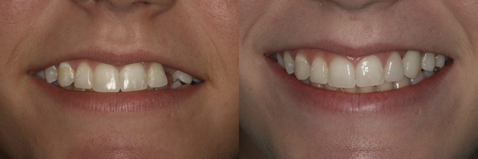 Case Study: The Missing Canine – A Puzzle with Functional and Esthetic ...