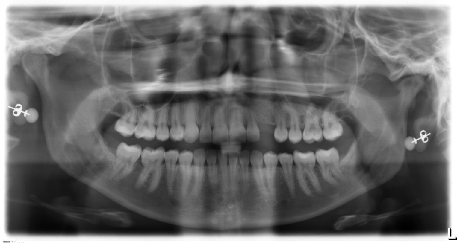 Case Study: The Missing Canine – A Puzzle with Functional and Esthetic ...
