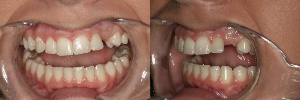 Case Study: The Missing Canine – A Puzzle with Functional and Esthetic ...