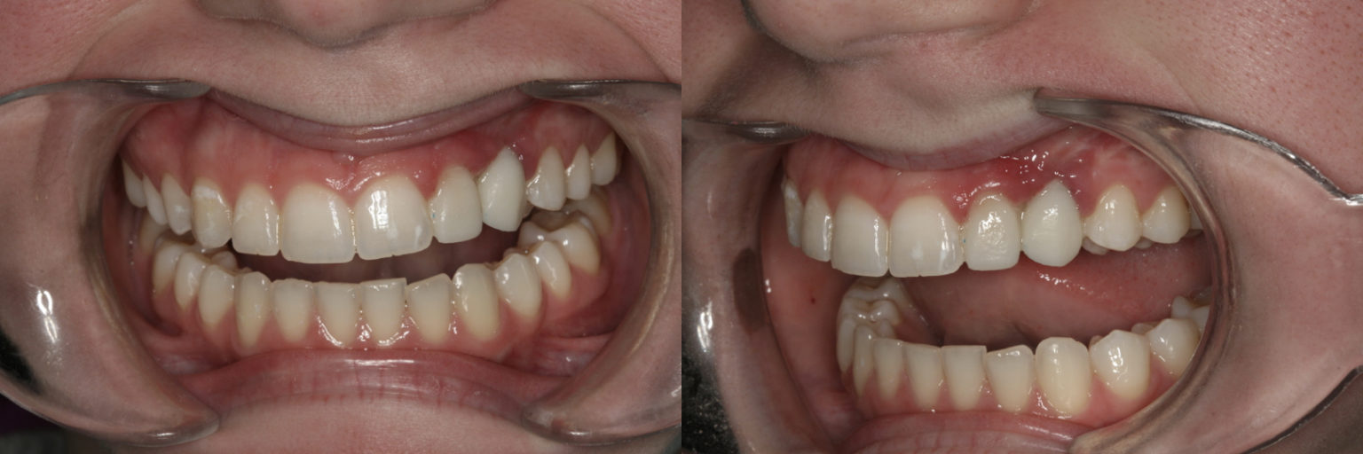 Case Study: The Missing Canine – A Puzzle with Functional and Esthetic ...