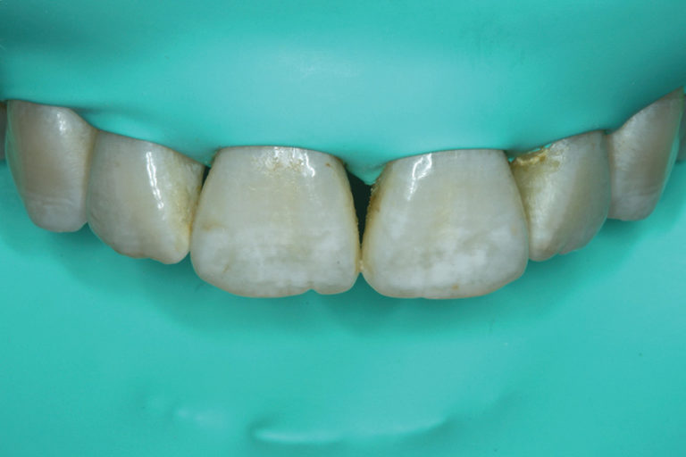 Resin Infiltration as Treatment for an Anterior Tooth Discoloration of ...