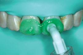 Resin Infiltration as Treatment for an Anterior Tooth Discoloration of ...