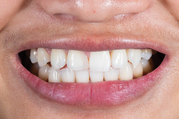 The “Single Tooth” Dilemma - Oral Health Group