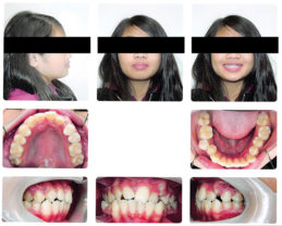 The “Single Tooth” Dilemma - Oral Health Group