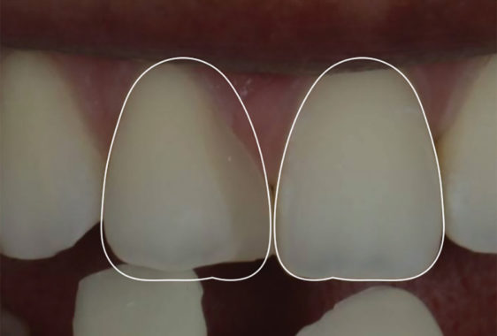 The “Single Tooth” Dilemma - Oral Health Group