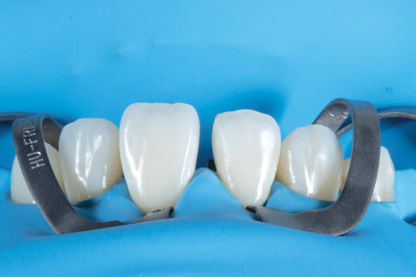 The “Single Tooth” Dilemma - Oral Health Group