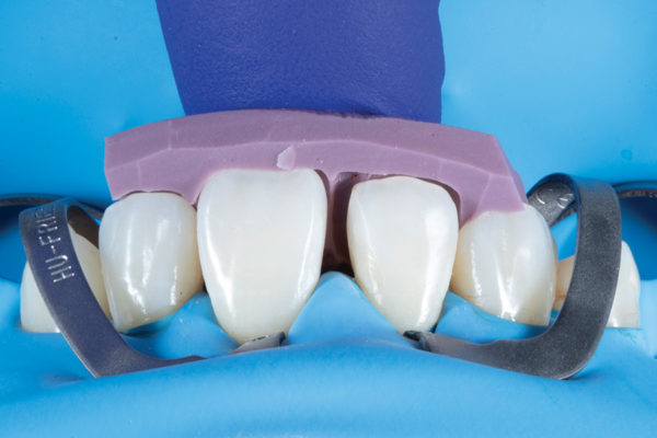 The “Single Tooth” Dilemma - Oral Health Group