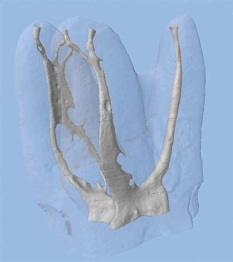 Continuous Wave of Condensation Revisited: A New Cordless Obturation System