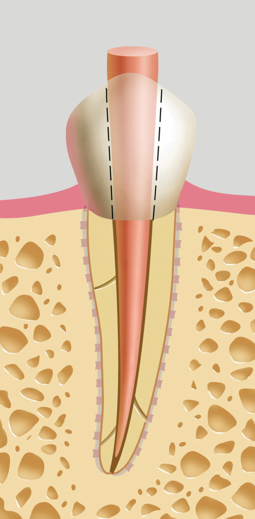 Glassman-Fig-#3A-Cone-Fit - Oral Health Group