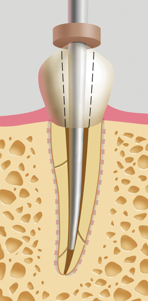 Continuous Wave of Condensation Revisited: A New Cordless Obturation System