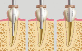 Continuous Wave of Condensation Revisited: A New Cordless Obturation System