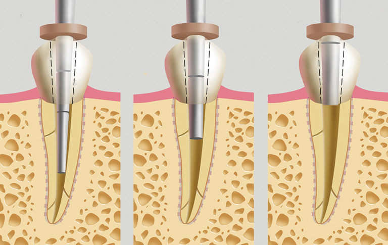 Continuous Wave of Condensation Revisited: A New Cordless Obturation System