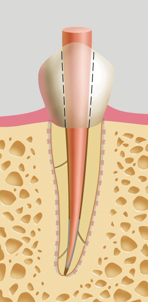 Continuous Wave of Condensation Revisited: A New Cordless Obturation System