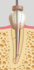 Continuous Wave of Condensation Revisited: A New Cordless Obturation System