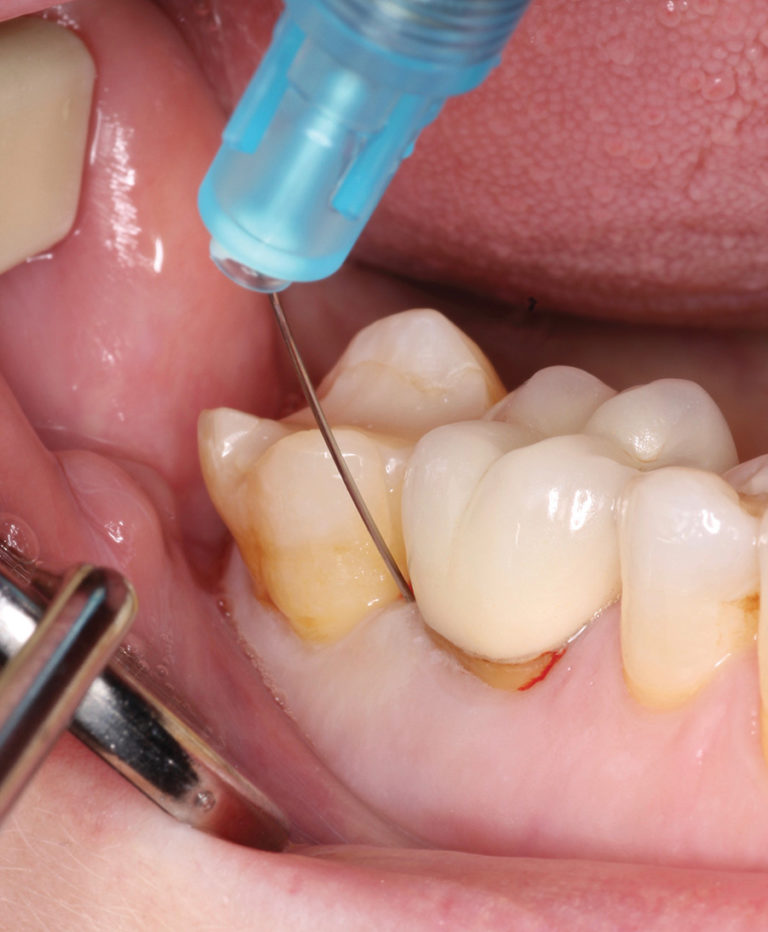 “Managing Endodontic Emergencies in the COVID-19 Era”