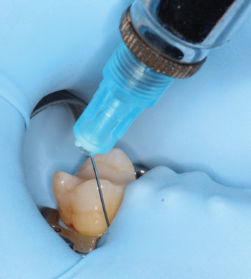 “Managing Endodontic Emergencies in the COVID-19 Era”