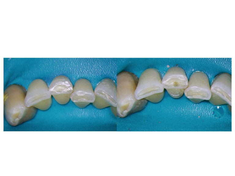 Armamentarium for Dentin Conservation During Endodontic Treatment ...