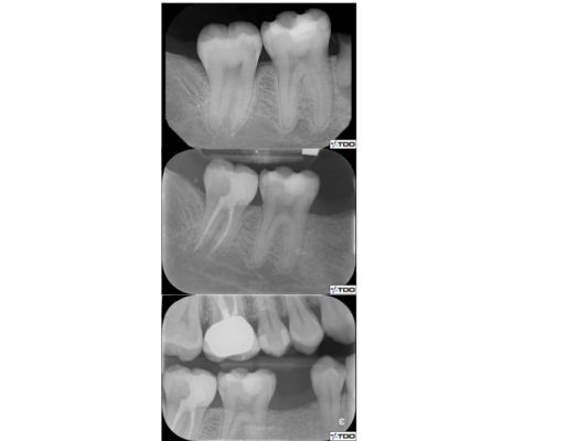 Armamentarium for Dentin Conservation During Endodontic Treatment ...