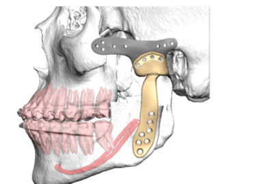 Treatment of a Large Mandibular Osteochondroma With Secondary ...