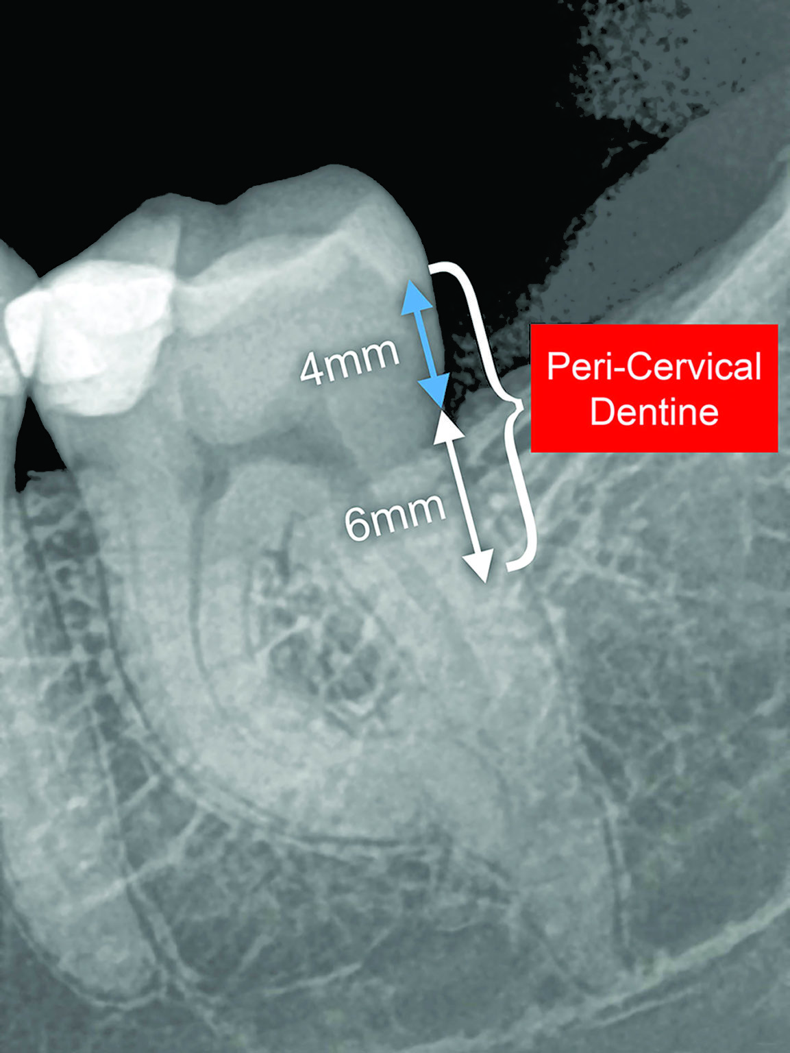 Minimally Invasive Endodontics Using a New Single-File Rotary System ...