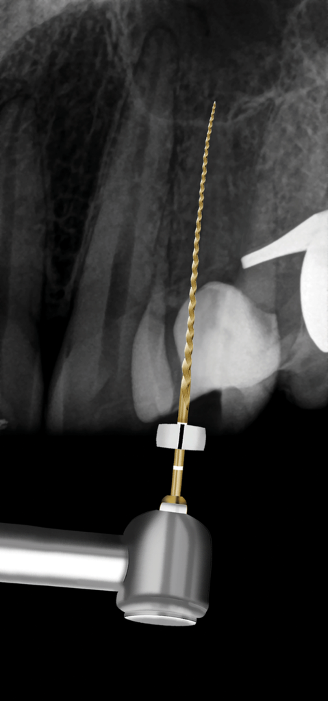 Minimally Invasive Endodontics Using a New Single-File Rotary System ...