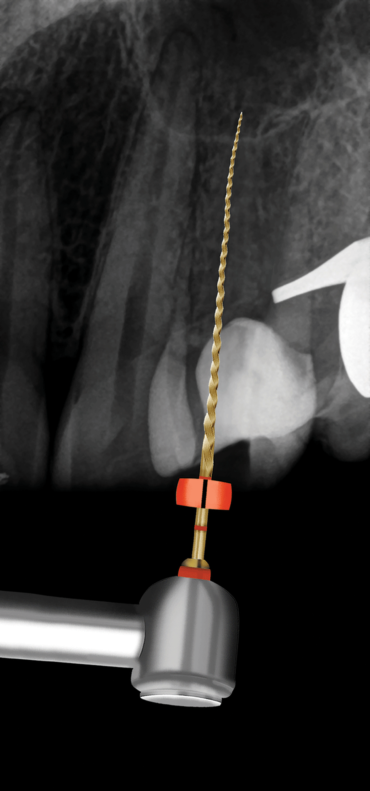 Minimally Invasive Endodontics Using a New Single-File Rotary System ...