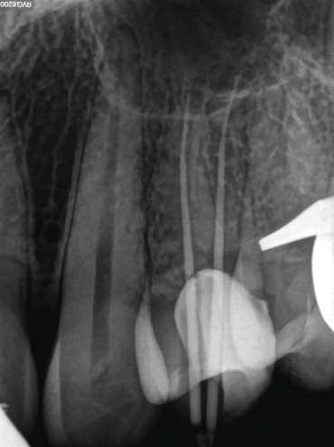 Minimally Invasive Endodontics Using a New Single-File Rotary System ...