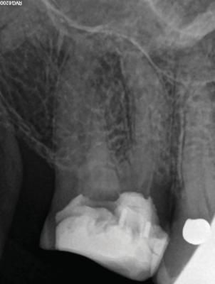Minimally Invasive Endodontics Using a New Single-File Rotary System ...