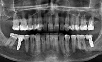 Minimal Invasive Prosthetic Procedures (MIPP) in Full Mouth Rehabilitation