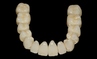 Minimal Invasive Prosthetic Procedures (MIPP) in Full Mouth Rehabilitation